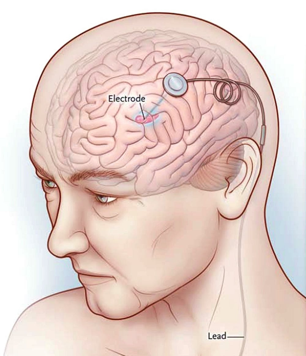 Deep brain stimulation can be effective for severe depression – Medisi ... Deep brain stimulation can be effective for severe depression – Medisi ...